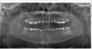 Surgical Uprighting of Teeth Oral Surgery Scarborough